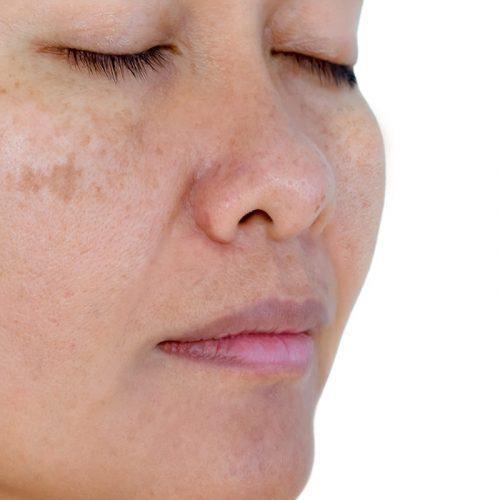 Le traitement des taches pigmentaires - Médecine esthétique